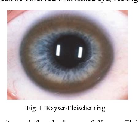 Kayser Fleischer Ring