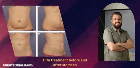 Hifu Treatment Before And After Stomach Real Results You Can Expect