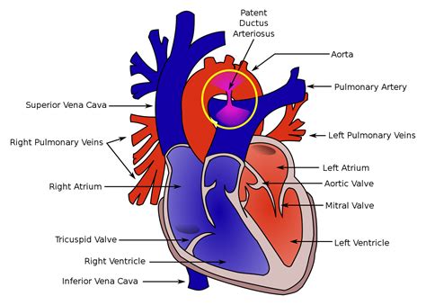 Patent Ductus Arteriosus Pda Murmur Geeky Medics