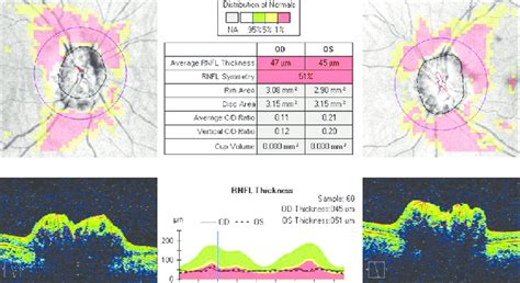 Oct Of Both Optic Nerves Showing Elevated Optic Nerve Heads And