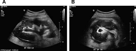 Ultrasound Of Renal Masses Radiologic Clinics