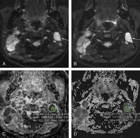 A 42 Year Old Male Patient With Diagnosed Npc And Bilateral Cervical