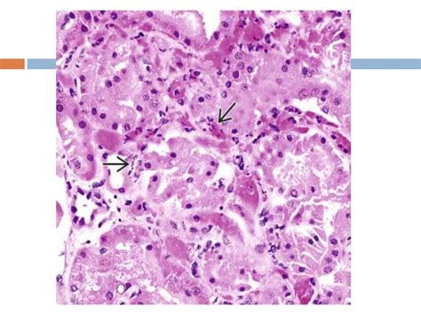 Hyperacute Rejection Of Renal Transplants Pptx Blood Disorders