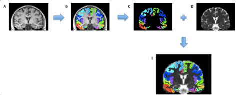 Cortical Parcellation And Measurement Of Cortical Md Each T1 Image A
