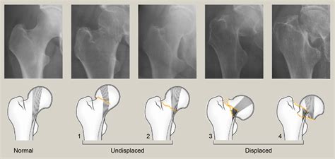 Garden Classification Of Hip Fractures My Xxx Hot Girl