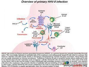 Pulmonary Kaposi Sarcoma Case Study Immunopaedia