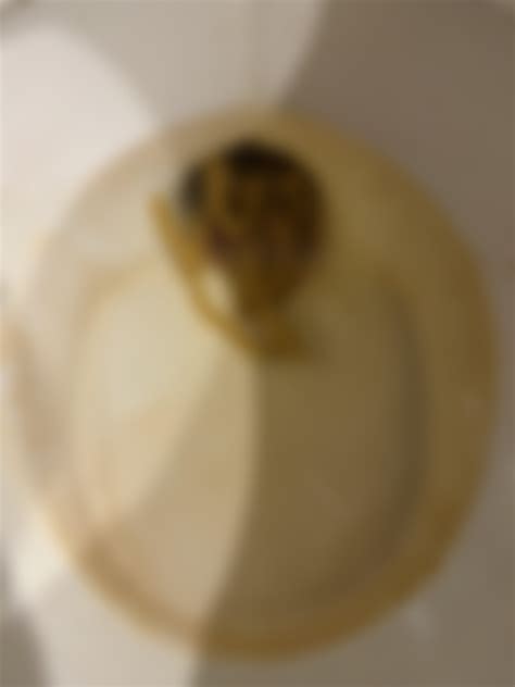 I Have Ulcerative Colitis And Hemorrhoids Should I Be Concerned About These Stools R