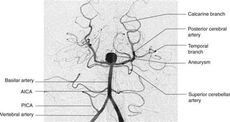 Cerebral Angiogram Circle Of Willis