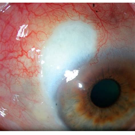 Necrotizing Scleritis Without Inflammation Or Scleromalacia Perforans