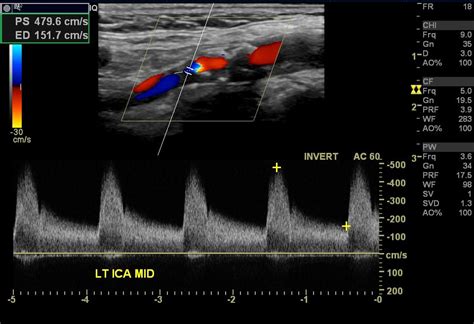 Ultrasound Imaging Vascular