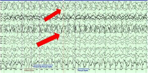 Partial Seizure Eeg Findings