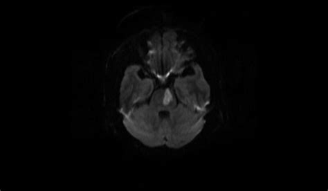 Lateral Pontine Syndrome Mri