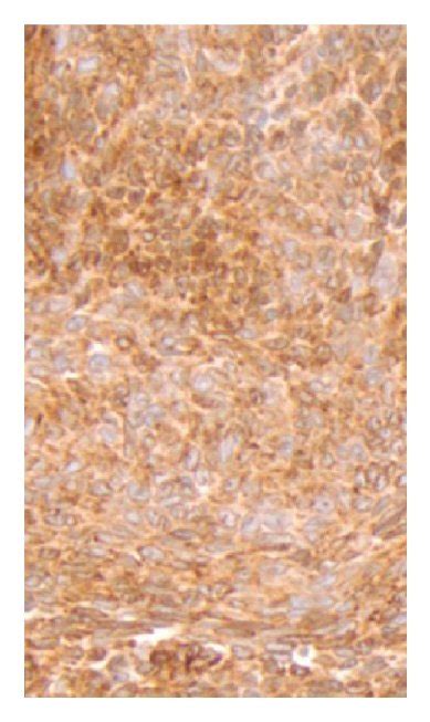 A Predominant Spindle Cell Pattern See Arrow Hande B Basaloid