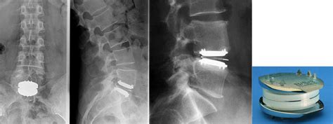Prótesis De Disco Lumbar Guillem Saló