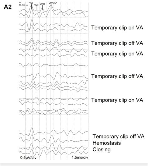 Waterfall Of Baep During The Procedure Baep Brainstem Auditory Evoked