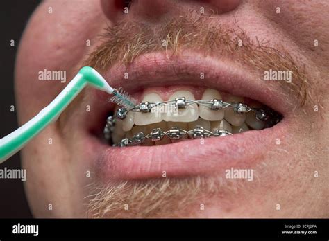 Adult Man Brushes His Teeth With Braces By Interdental Brush Stock