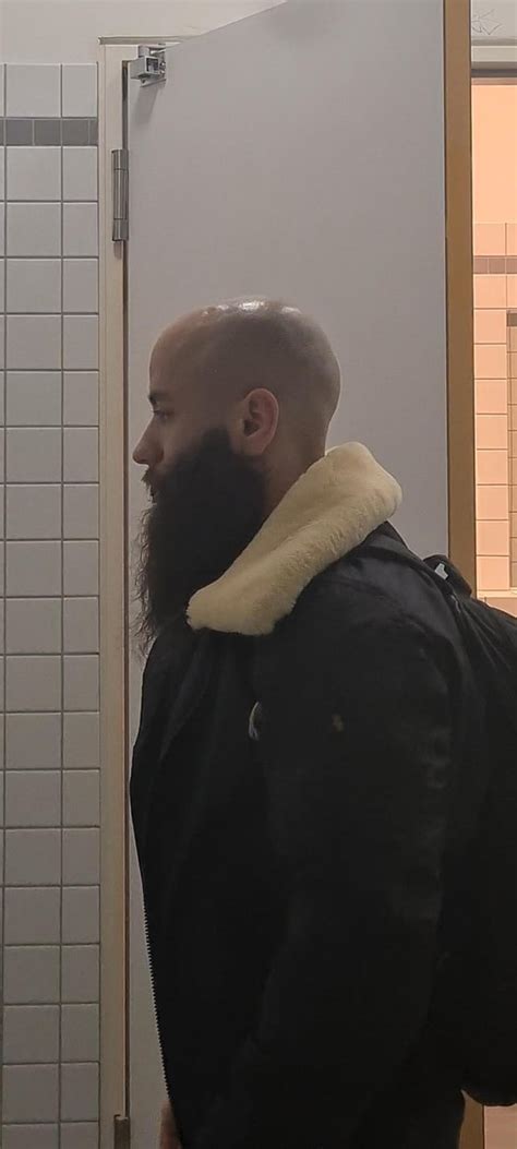 Is My Maxilla Flat Is It Average Recessed 🤔 Do I Need Surgery R