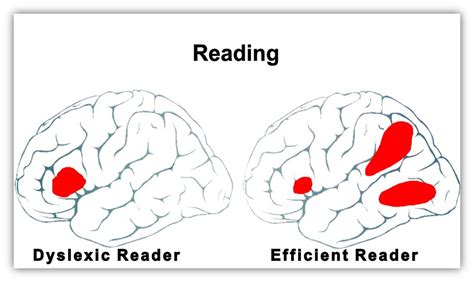 The Causes Of Dyslexia What The Latest Science Reveals