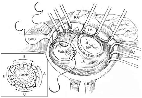 Occlusion Of The Laa Orifice With A Biomatrix Patch Cormatrix Ecm