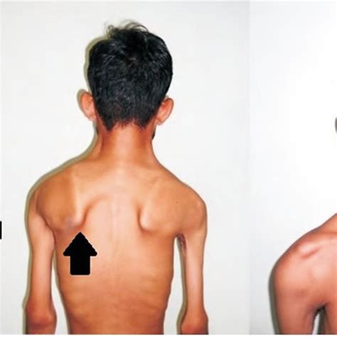 Polyphasic Small Short Muap With Early Recruitment Pattern In Right