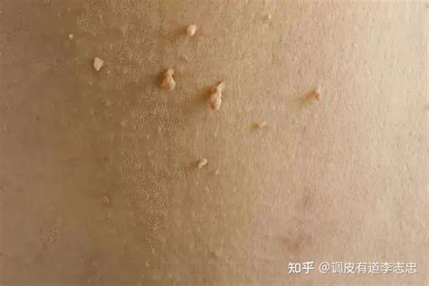警惕！身上出现这5种疣体，与hpv病毒感染有关！ 知乎