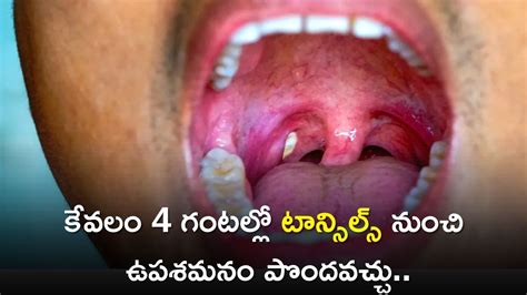 If You Drink Green Tea And Barley Water Can Reduce Tonsils In 4 Hours