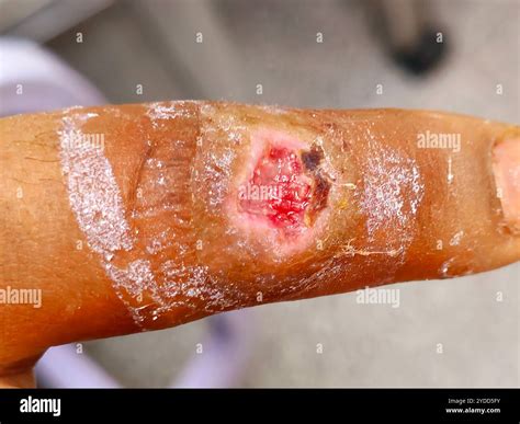 An Abscess That Was Drained From Pus And Cleaned Surgically For