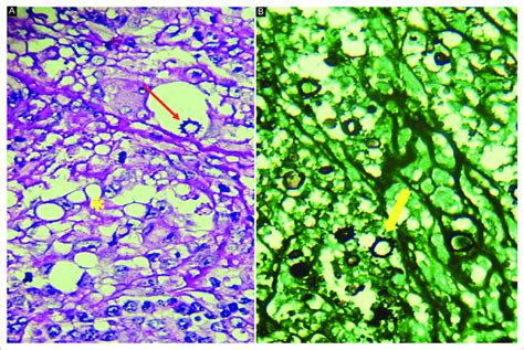 Lymph Node Biopsy A Hematoxylin Eosin He Stain 400x Chronic