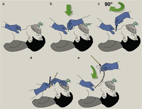 Evaluation And Management Of Acute Upper Airway Obstruction Surgery
