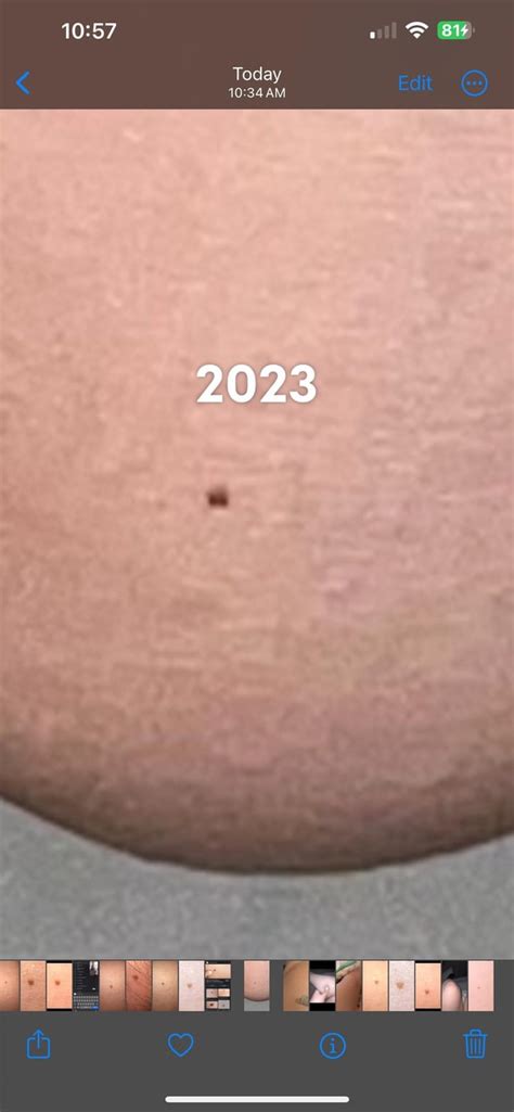 Normal Mole Rdermatologyquestions