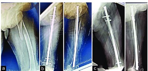 Spiral Fracture Femur