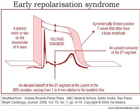 Emerging Truths About Early Repolarisation Syndrome Dr S Venkatesan Md