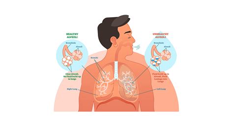 Pulmonary Vascular Congestion An Overview