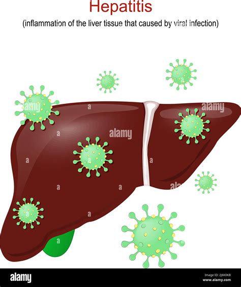 Hepatitis Inflammation Of The Liver Tissue That Caused By Viral