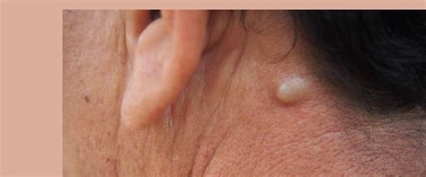 How To Remove A Sebaceous Cyst Without Surgery