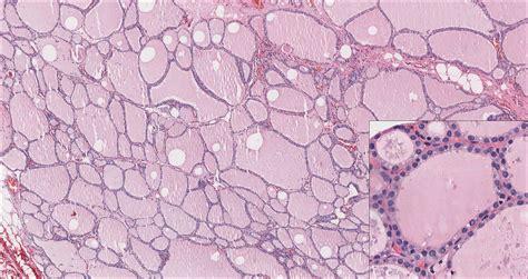 Thyroid Normal Histology Nus Pathweb Nus Pathweb