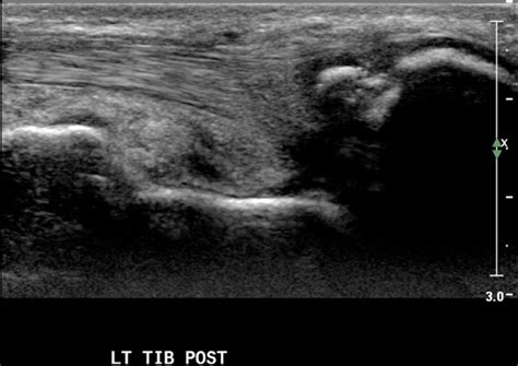 Posterior Tibial Tendon Ultrasound Posterior Tibial Tendinitis