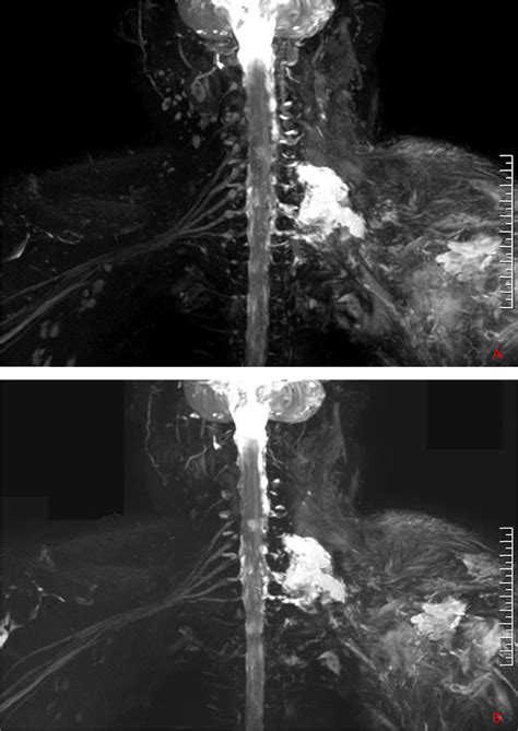 Brachial Plexus Mri With Contrast