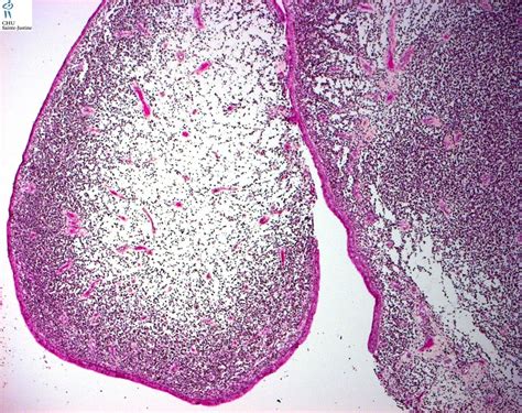 Rhinopharyngeal Embryonal Rhabdomyosarcoma Humpathcom Fundamentals Of