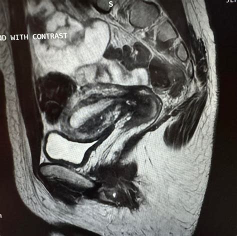 Mri Findings Suggestive Of Mild Adenomyosis Radenomyosis