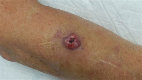 Clinical Quick Quiz What Is The Most Appropriate Management Option