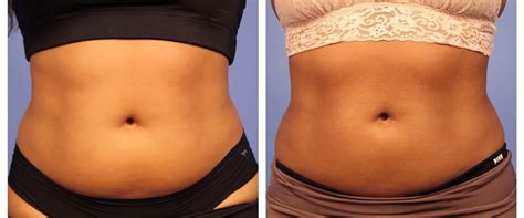 Does Cool Coolsculpting Really Work