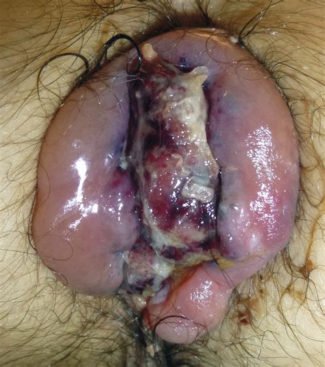 Prolapsus Hémorroïdaire Interne Thrombosé La Revue Du Praticien