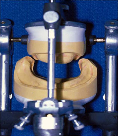 Class Iii Denture My Dental Technology Notes