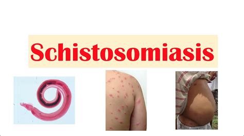 Schistosomiasis Bilharziasis Causes Symptoms And Treatment Youtube
