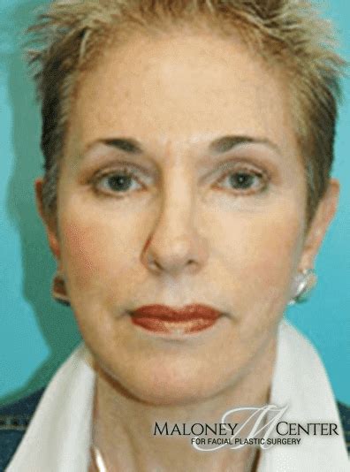 Eyelid Surgery Maloney Center For Facial Plastic Surgery