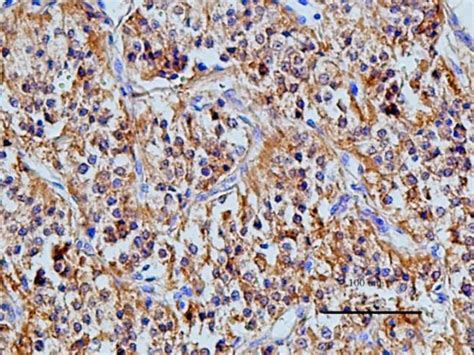 Expression Of Chromogranin A In Cytoplasm Of Chemodectoma Cells