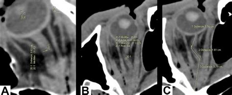 Three Dimensional Multiplanar Reconstruction Indicates A Optic Nerve Download Scientific