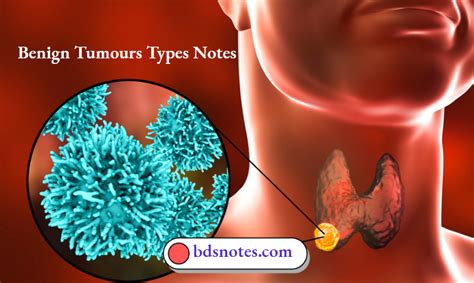 Benign Tumours Types Notes Bds Notes
