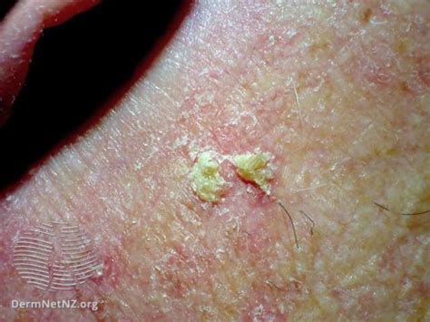 Seborrheic Keratosis Symptoms Causes Diagnosis And Treatment
